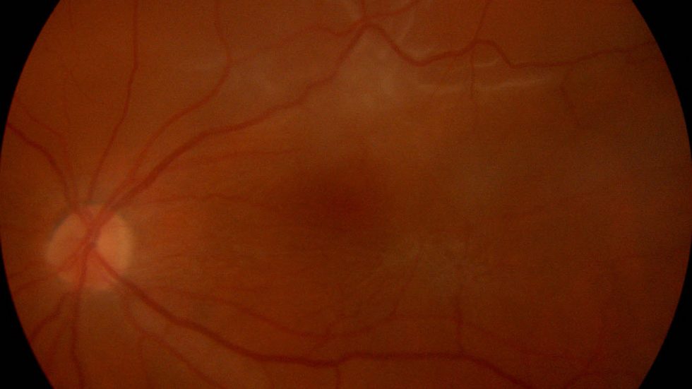 Les maladies de la rétine - Centre Ophtalmologique Transparence Tours